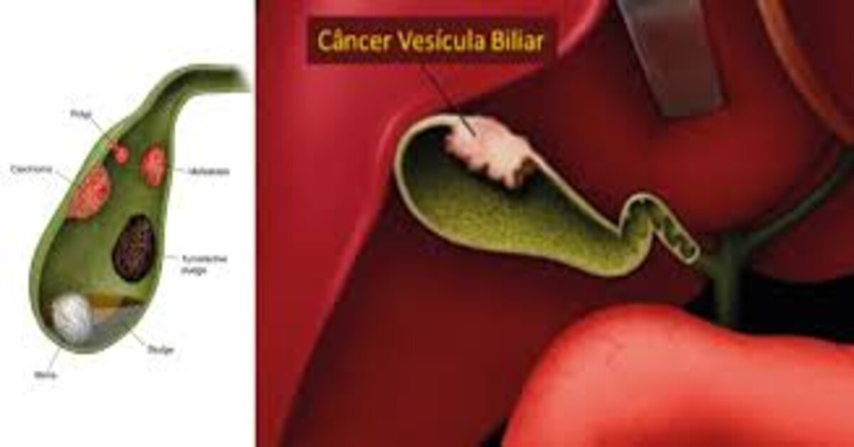 Fique atento aos 11 sinais de câncer de vesícula