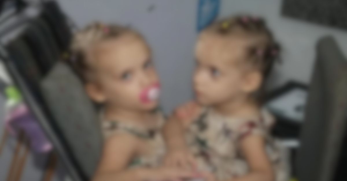 Quem são e como estão as gêmeas siamesas que passaram por cirurgia de ... Quem são e como estão as gêmeas siamesas que passaram por cirurgia de ...