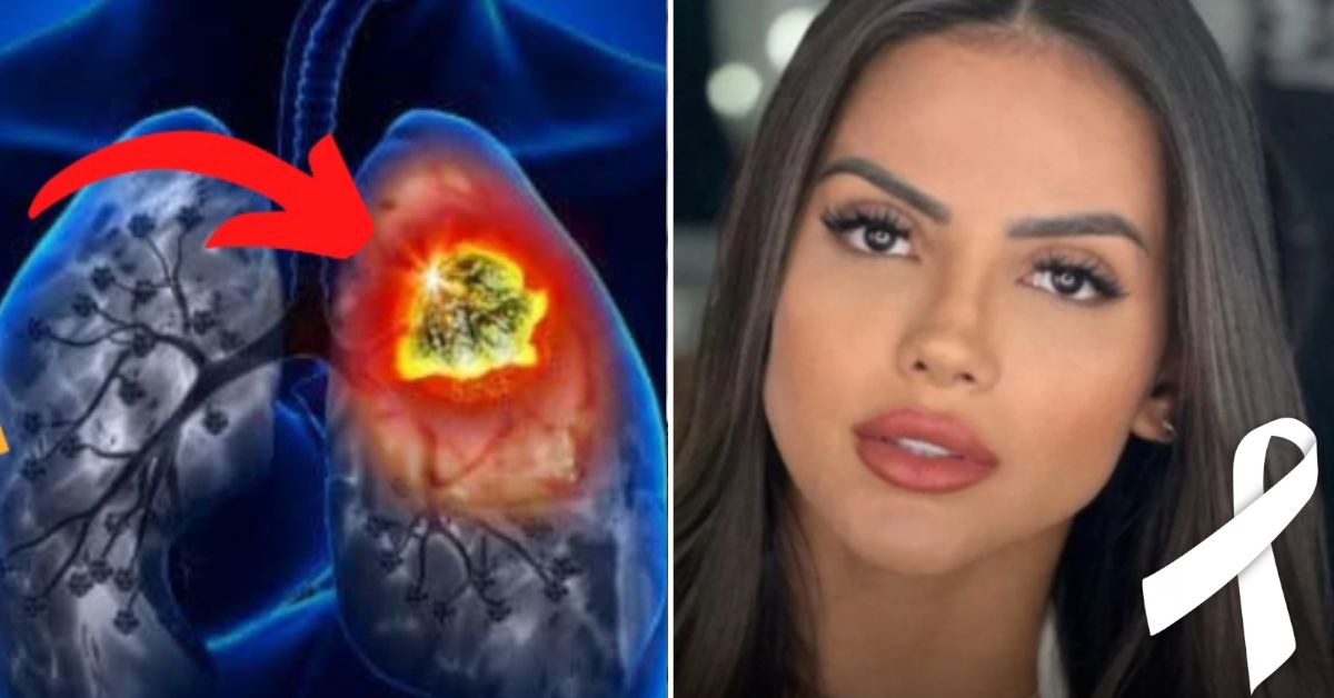 Embolia pulmonar maciça: O que é e quais são os sintomas desta condição ...