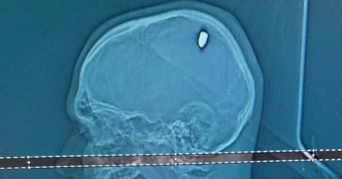 Jovem fica com bala alojada após ser atingido por bala perdida no Ano ...